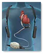 FDA approves Heart Mate II – Blood Pump for the Heart for Patients With ...